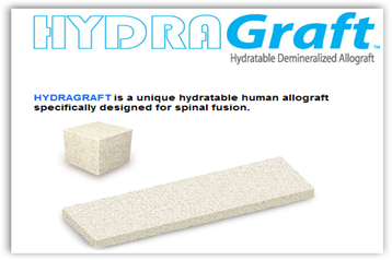 X-spine Announces New FDA Product Approval for Spinal Fusion–Minimally ...